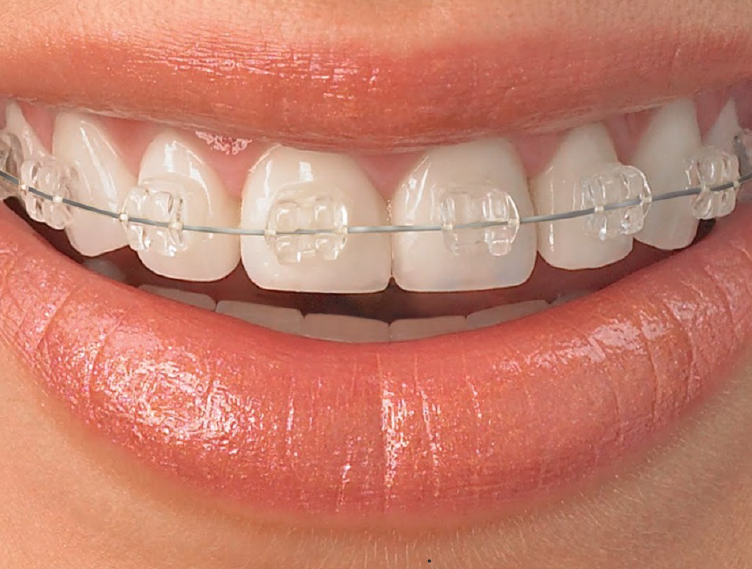 Brackets: ¿Cuáles son sus Beneficios y Tipos? - Clinica Dental del Country