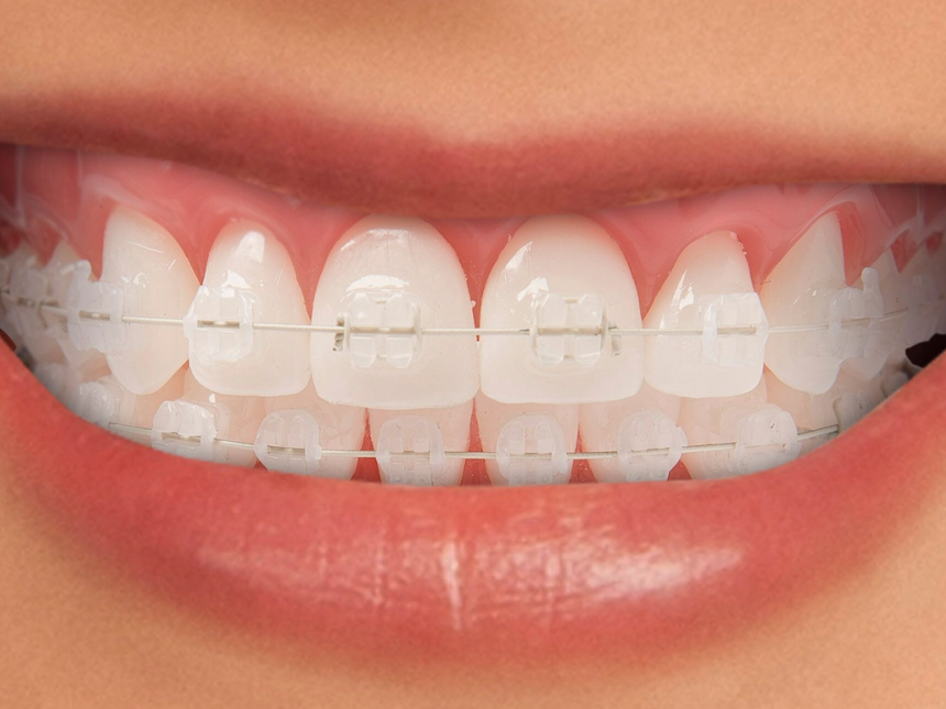 Brackets: ¿Cuáles son sus Beneficios y Tipos? - Clinica Dental del Country